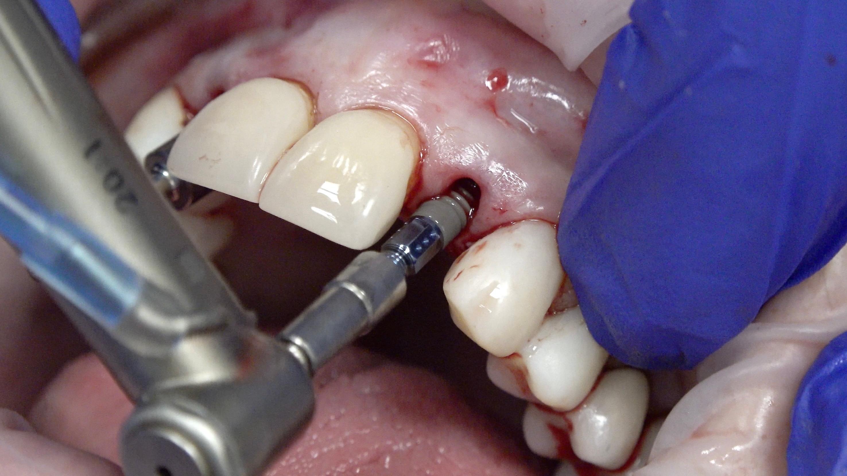 Implant Case Studies Webinar